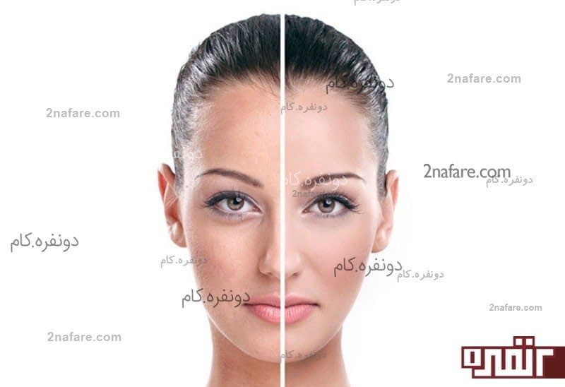 روش های خانگی درمان جوش و آکنه • دونفره